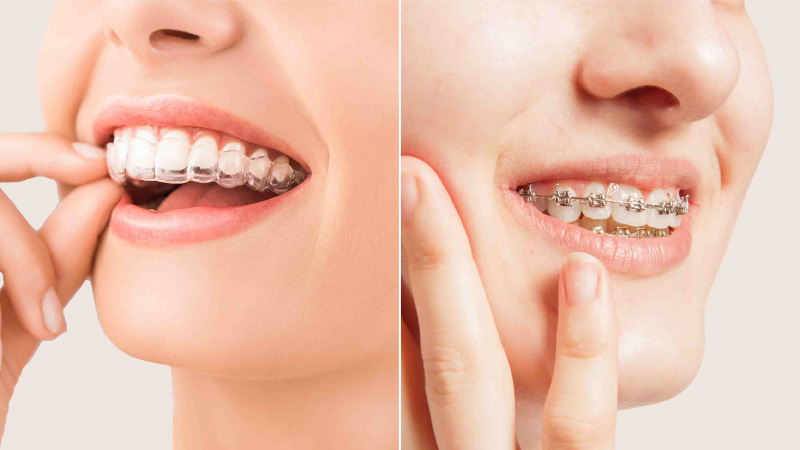 Teeth Straightening in Edinburgh: Invisible Aligners vs. Braces - News ENU
